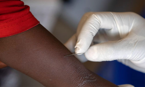 Existen cinco casos viruela del mono en Ecuador » QuieroTv